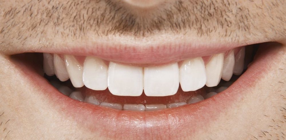 Professionelle Zahnaufhellung in der Praxis - Bleaching, Zahnaufhellung ...